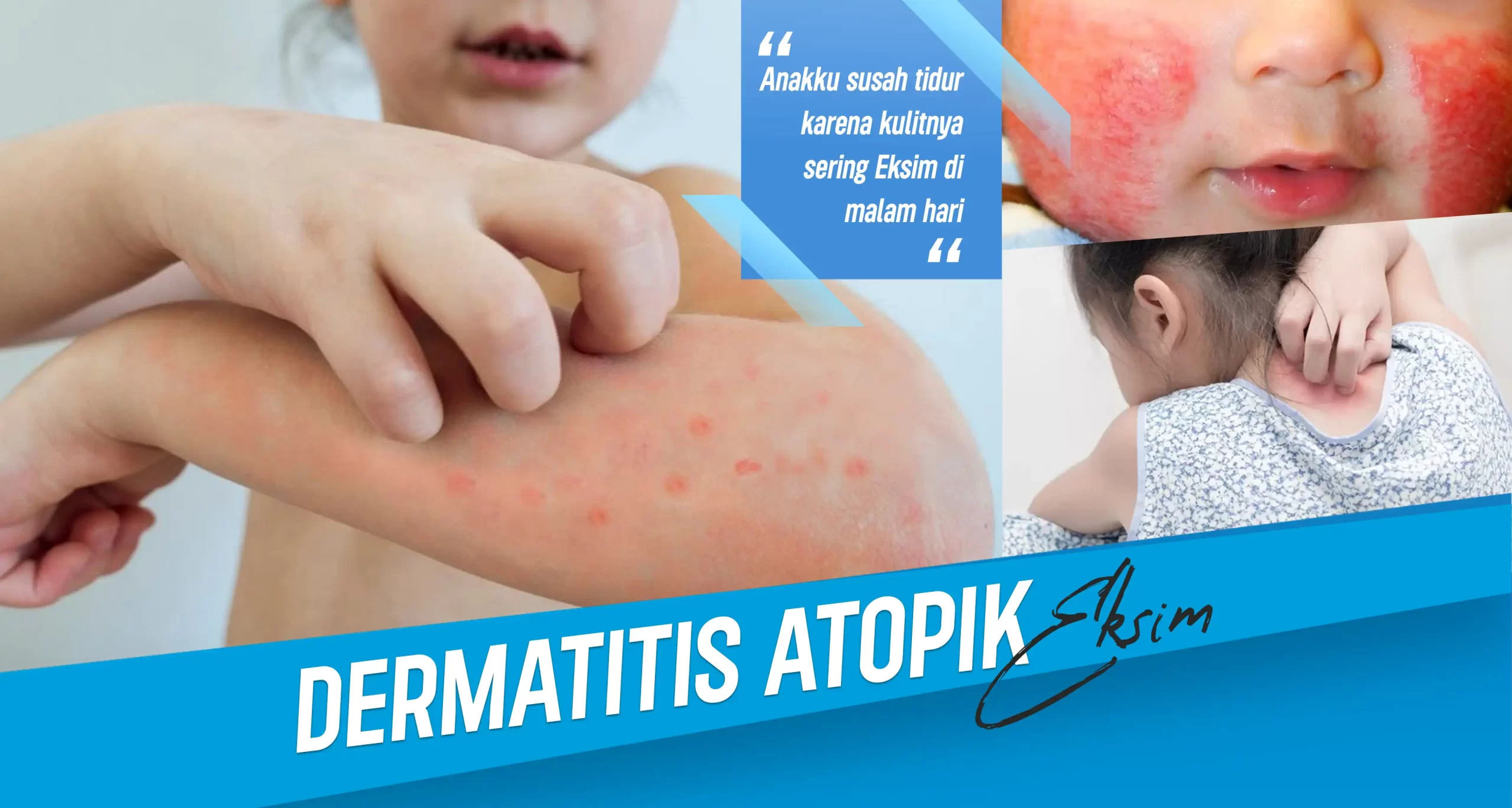 DERMATITIS ATOPIK / EKSIM - GBI Pasir Koja 39 Bandung